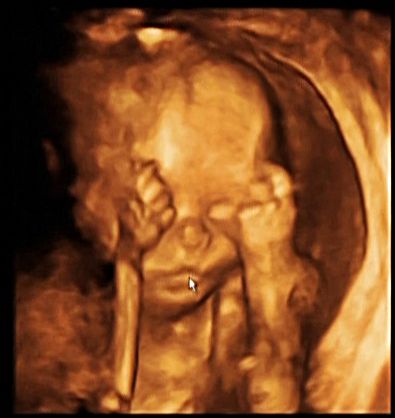 Baby Lanterme: 22 week scan
