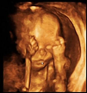 Baby Lanterme: 22 week scan