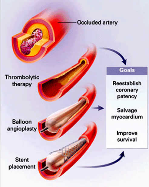 Terapia Trombolitica