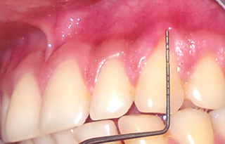 Orthodontic Corner: Post Orthodontic Recession Defects, Modified Approach