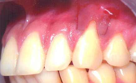 Orthodontic Corner: Post Orthodontic Recession Defects, Modified Approach