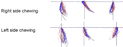 Orthodontic Corner: Mandibular deviation and canted maxillary occlusal ...