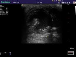 Urologia San Lorenzo: Orquitis