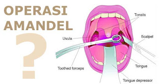 Operasi Amandel? perlukah? | Lamandel :: solusi sehat amandel, tanpa ...