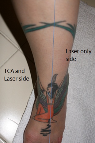 Removng my tattoo with laser and TCA peel: Outline: Tattoo removal blog ...