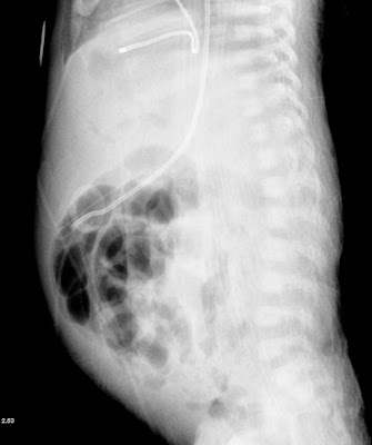 The Proud Preemie Mommy: NEC - Necrotizing Enterocolitis