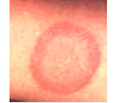 cathypharmaderm: MYCOSES