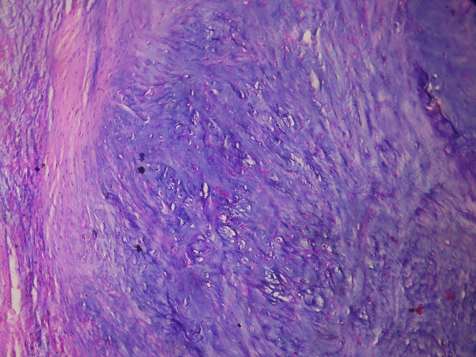 My Pathology: extra osseous chondroma