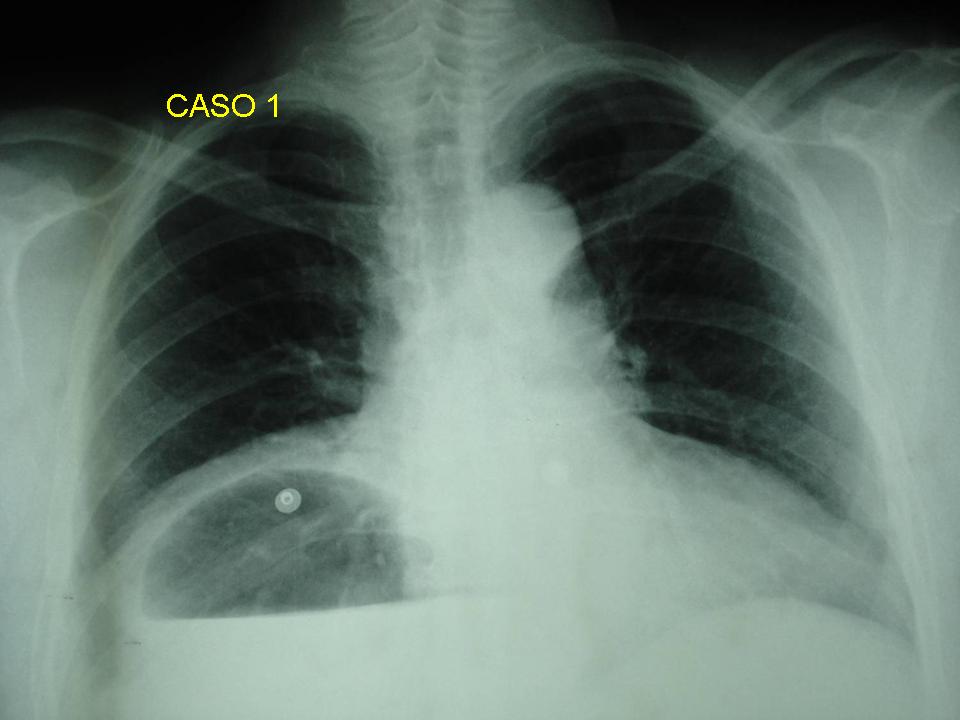 ALFREDO JIMÉNEZ BERNADÓ: HERNIA DE LARREY MORGAGNI: TRATAMIENTO POR ...