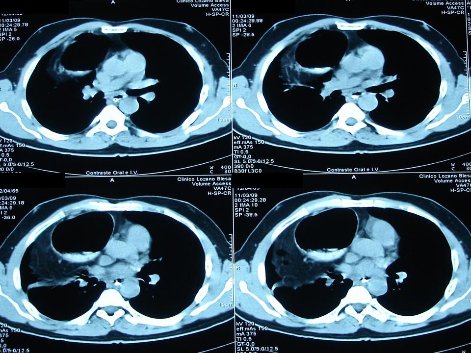 ALFREDO JIMÉNEZ BERNADÓ: HERNIA DE LARREY MORGAGNI: TRATAMIENTO POR ...