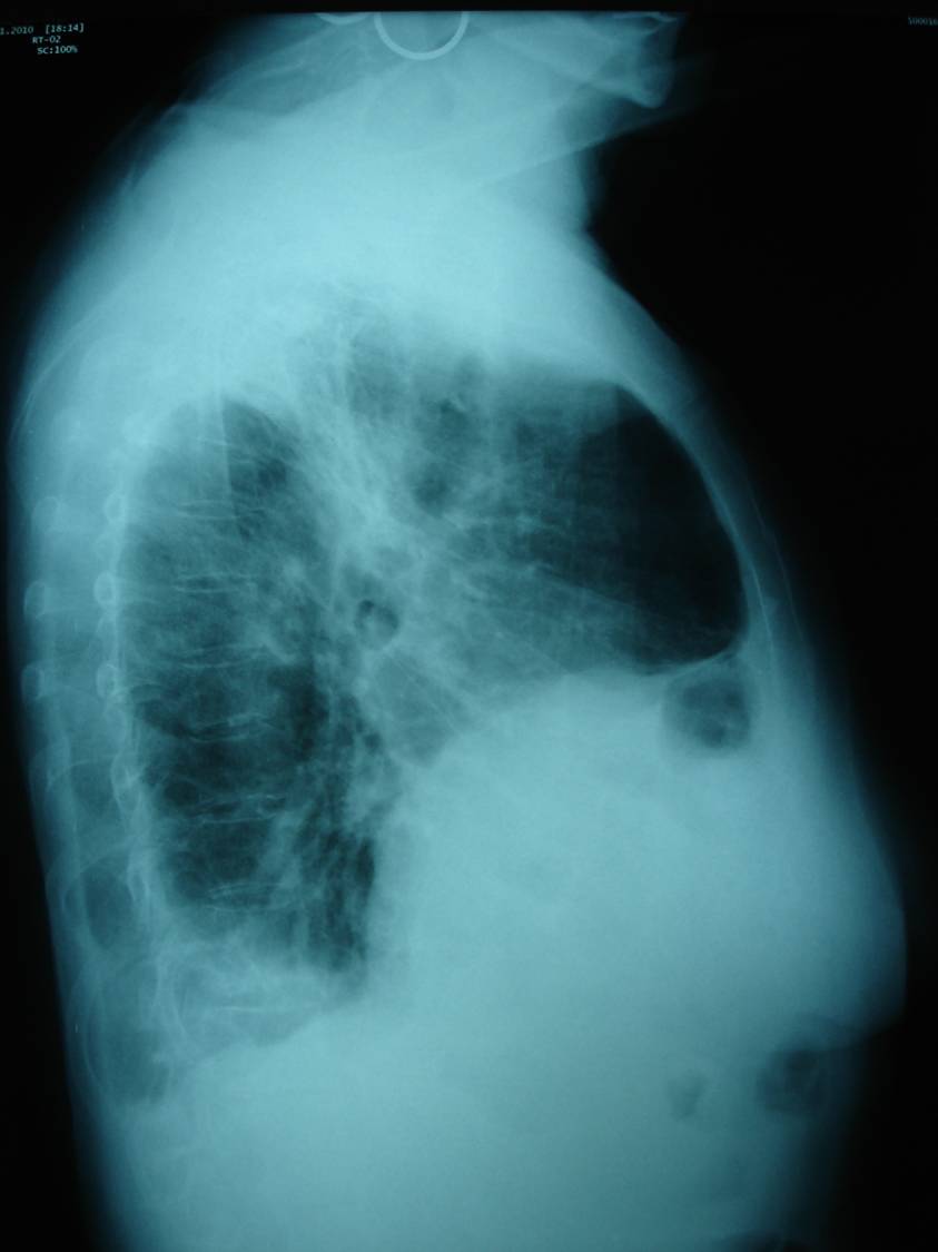 ALFREDO JIMÉNEZ BERNADÓ: HERNIA DE LARREY MORGAGNI: TRATAMIENTO POR ...