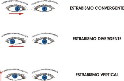 Defeitos Da Visão: Defeitos Da Visão : Estrabismo