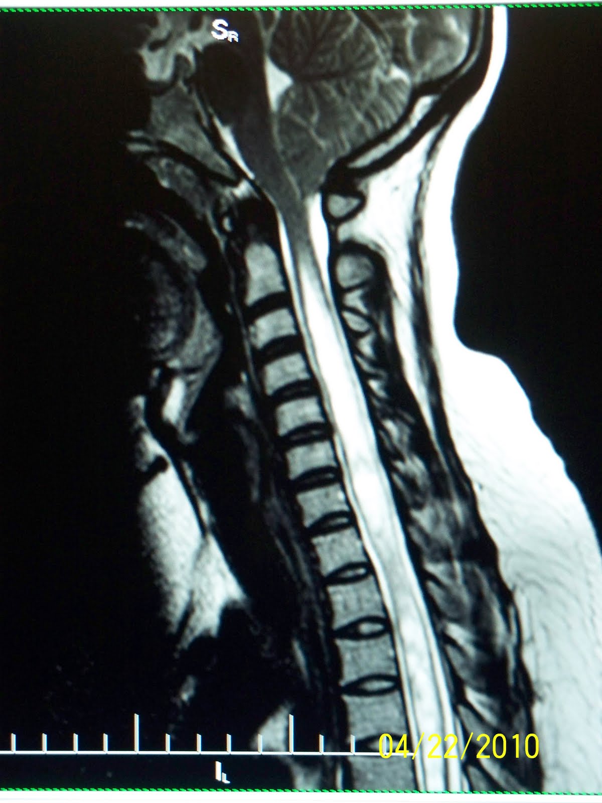 MRI Clinicals: Syrinx and Chiari Malformation