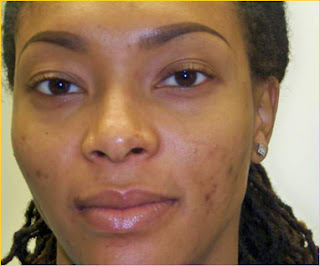African American and Ethnic Acne Treatment: Before and After Photos
