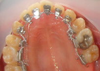 Odontologia Peru: Brackets Internos o Ortodoncia Lingual