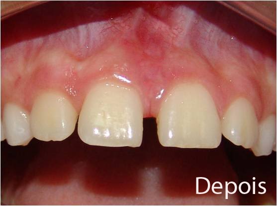 Freio Labial; Frênulo do Lábio