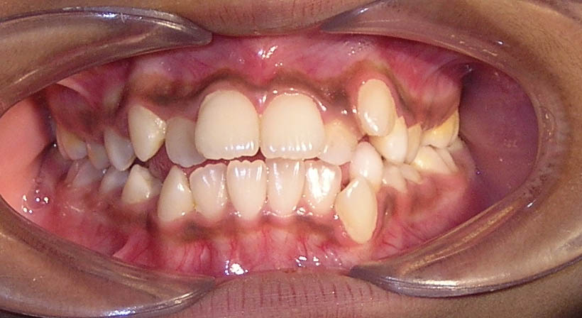 Smile makeovers - Different problems, Different solutions: Dental ...