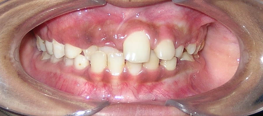 Smile makeovers - Different problems, Different solutions: Dental ...