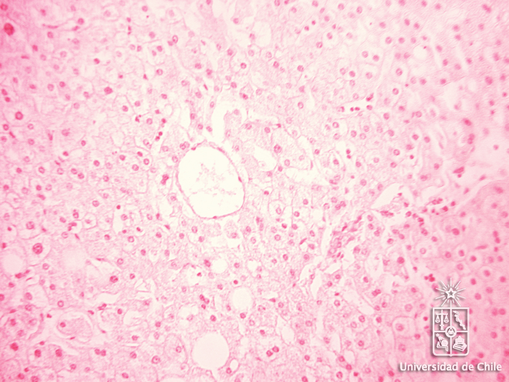 Atlas de Anatomía Patológica: Microfotografías de Tumefacción turbia ...