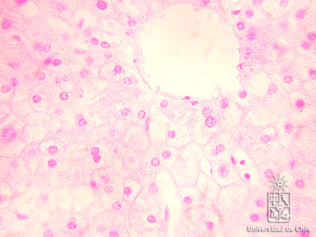 Atlas de Anatomía Patológica: Microfotografías de Tumefacción turbia ...