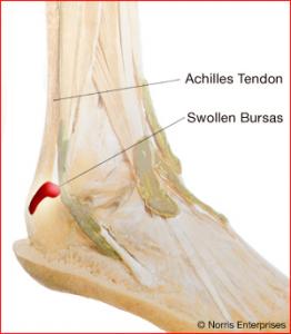 Achilles Tendon Bursitis