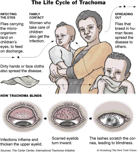 Trakoma - Terapi Sehat : Info Kesehatan Medis dan Alternatif