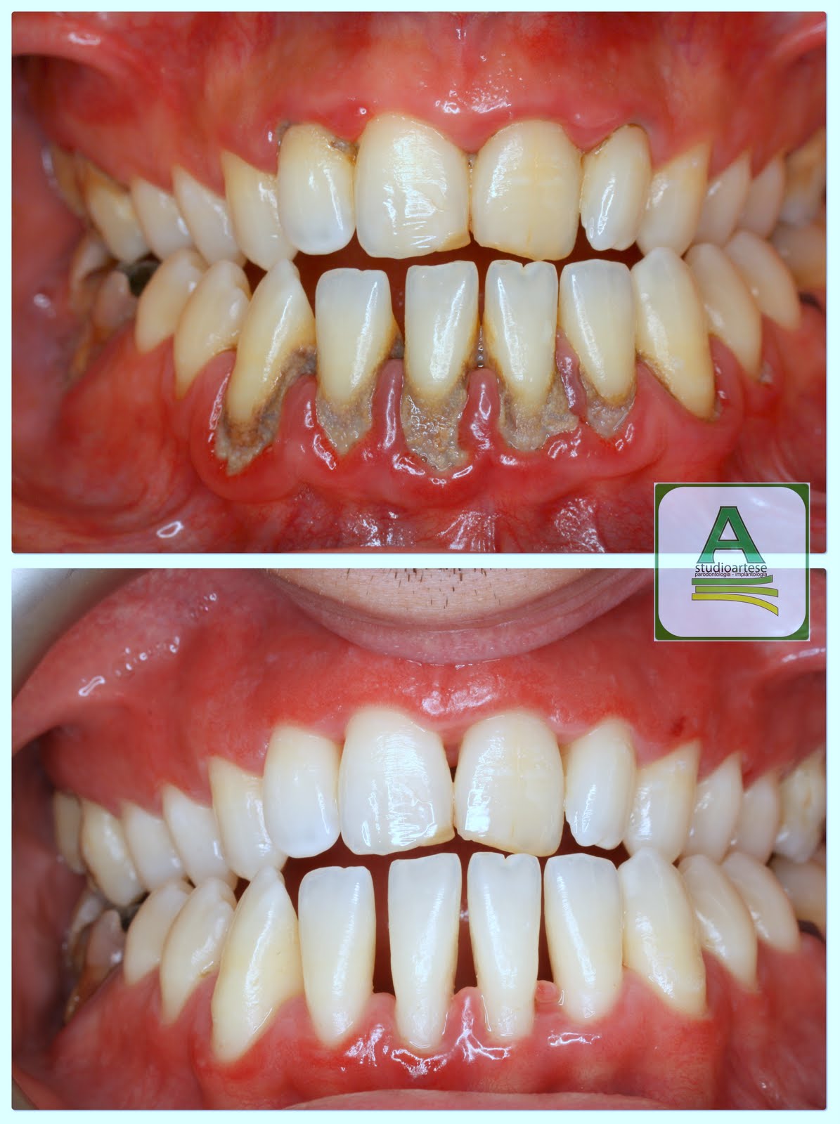 Studio dentistico dr. Alessandro Artese: Parodontologia