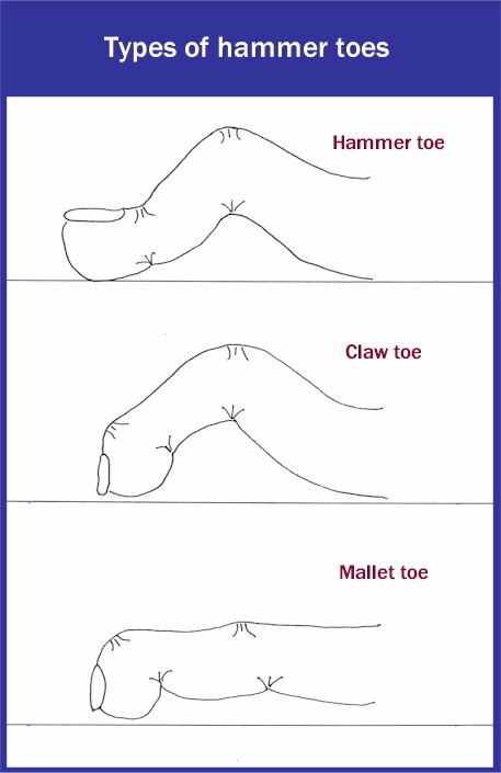 Shenandoah Podiatry: Hammertoes