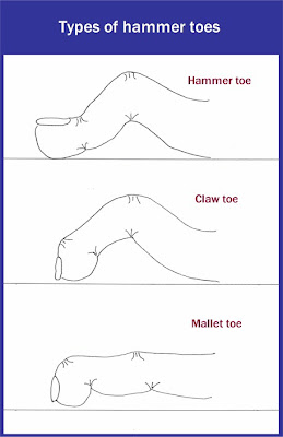 Shenandoah Podiatry: Hammertoes