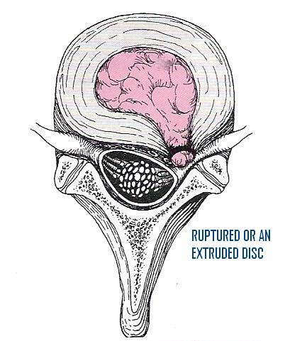 Herniated Disc? Ruptured Disc? Prolapsed Disc? What is the Difference?