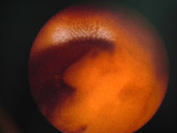 MEDICINA. BLOG DE OSCAR FRISANCHO.: DOLICOMEGACOLON