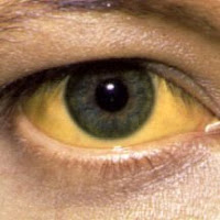 Captains Medic Photos: Jaundice (Ικτερος)