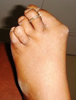 Captains Medic Photos: Rheumatoid Arthritis (Ρευματοειδης Αρθριτιδα)