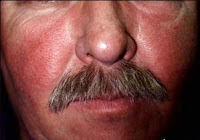 Captains Medic Photos: Systemic Lupus Erythematosus (Συστηματικος ...