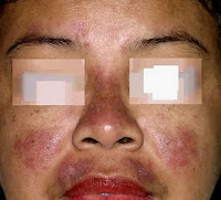 Captains Medic Photos: Systemic Lupus Erythematosus (Συστηματικος ...