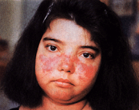 Captains Medic Photos: Systemic Lupus Erythematosus (Συστηματικος ...
