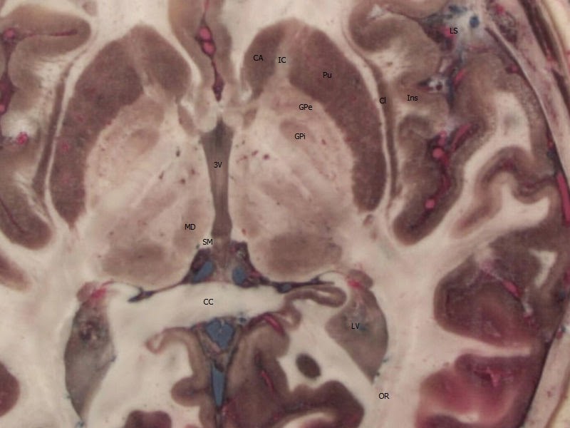 Anatomiczny: Szczegółowe zdjęcia przekrojów poprzecznych mózgowia