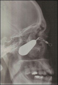 Fly Fish Addiction: Fly Fishing Injuries and How to Prevent Them!