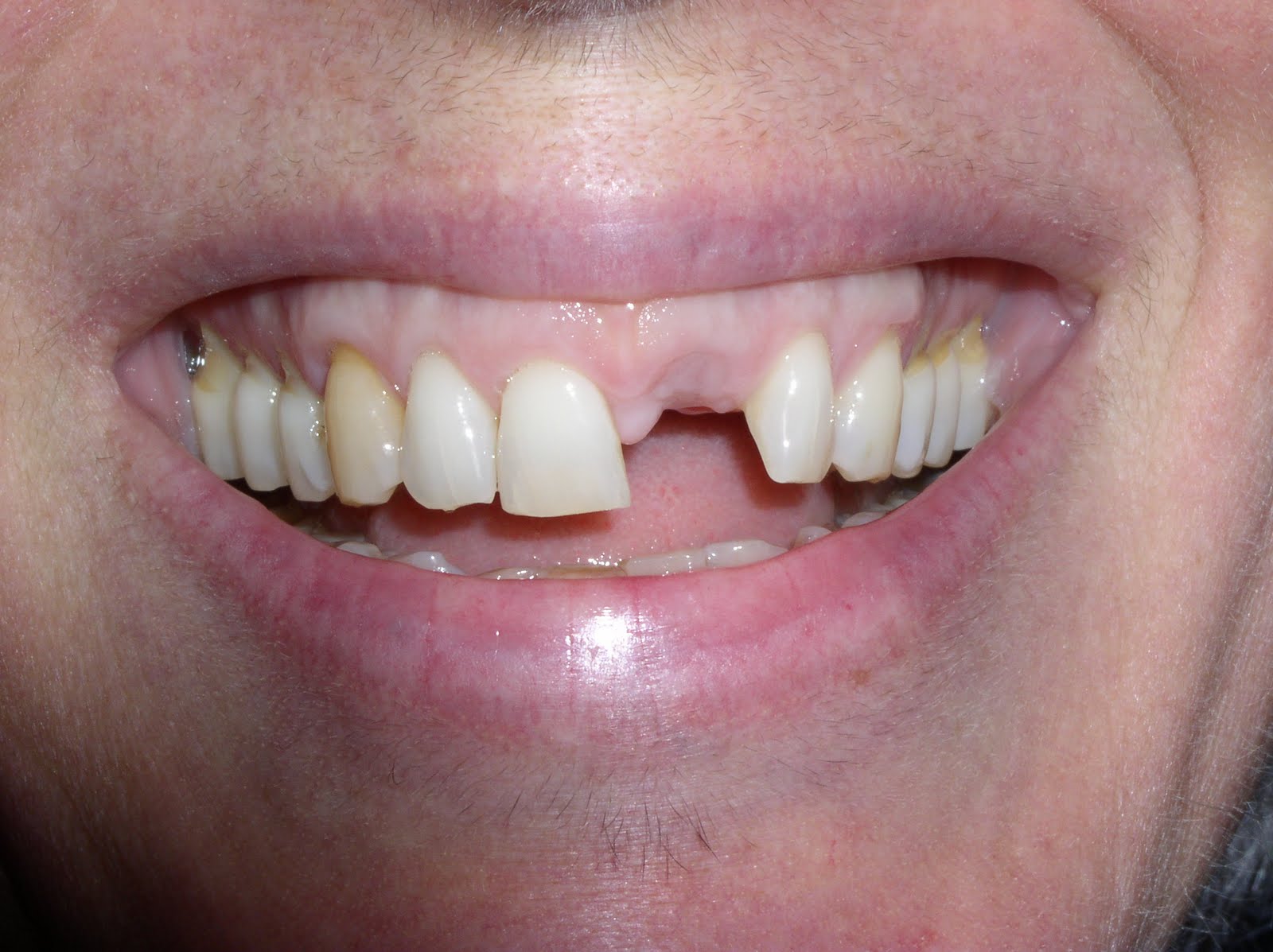 Periodontal - Implant Cases by Dr. Thomas Kang: Anterior implant placement