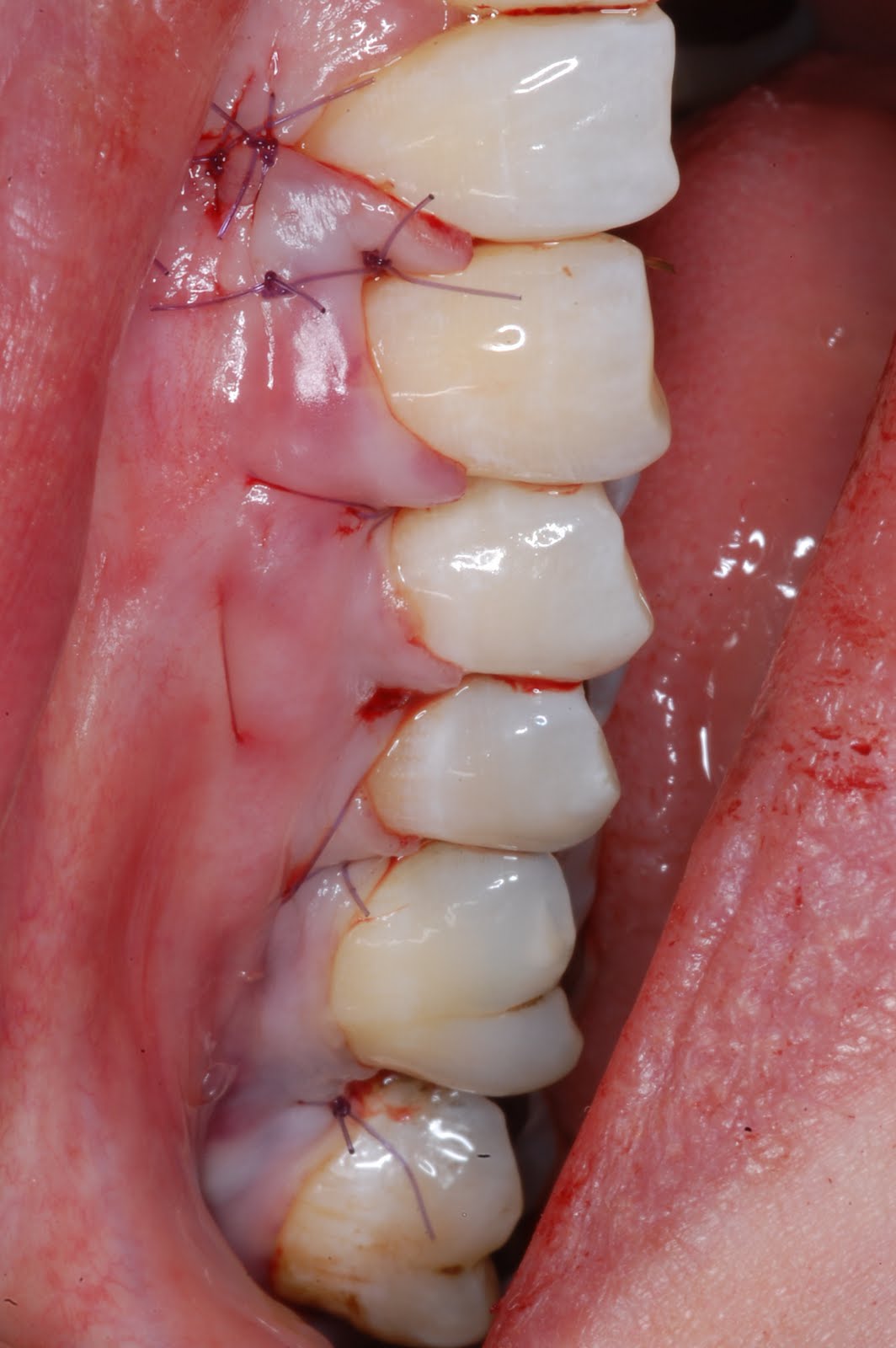 Periodontal - Implant Cases by Dr. Thomas Kang: Connective tissue grafting