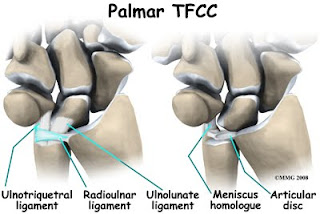 Triangular Fibrocartilage Complex Tear: What is a triangular ...