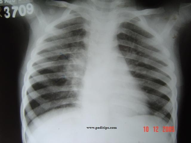 medical pics: Ghon's complex