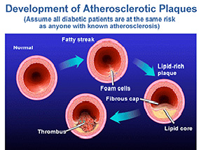 basic health: Signs and Symptoms of Dyslipidemia