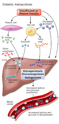 歲月麻醉: DKA 的治療 與 Cerebral edema