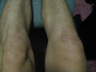ACL SURGERY RECOVERY: Recovering from ACL surgery: Week 3 - ACL Surgery ...