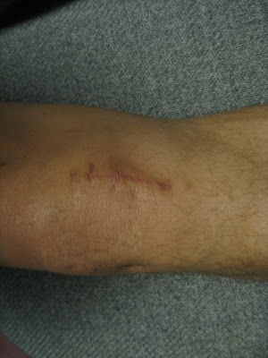 ACL SURGERY RECOVERY: Recovering from ACL surgery: Week 5- ACL Surgery ...