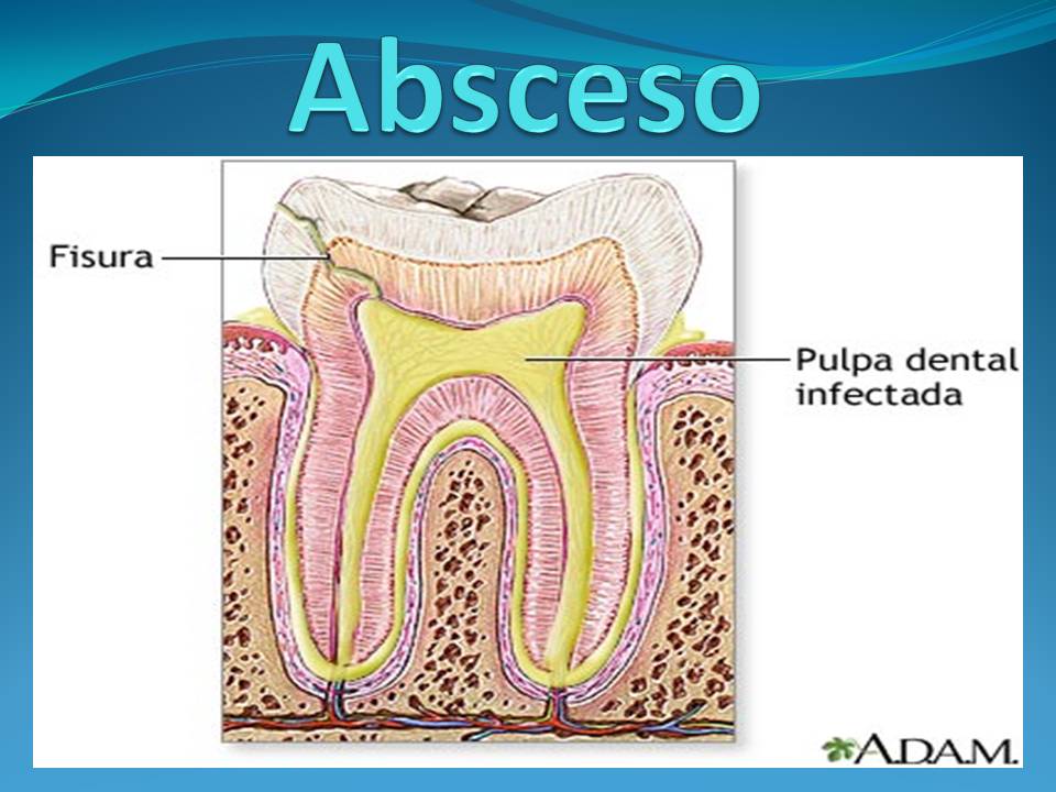 ALTERACIONES BUCALES FES ZARAGOZA: ABSCESO AGUDO, CRONICO Y FENIX
