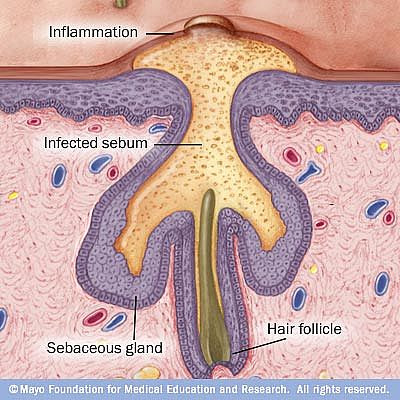 O Melhor da Biologia: Bactéria causadora do acne: como combatê-la