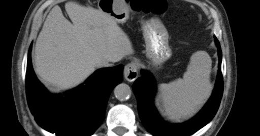 Buckeye Surgeon: Laparoscopic Gastric GIST resection