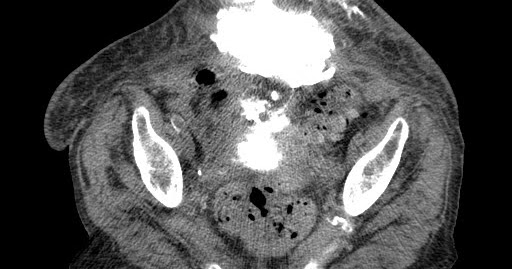 Buckeye Surgeon: Traumatic Bladder Rupture